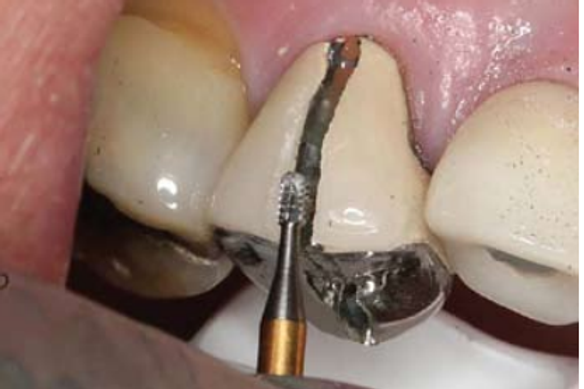 Burs: The Cutting Edge – Mr Bur