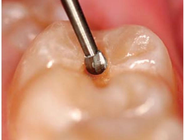 Burs: The Cutting Edge – Mr Bur