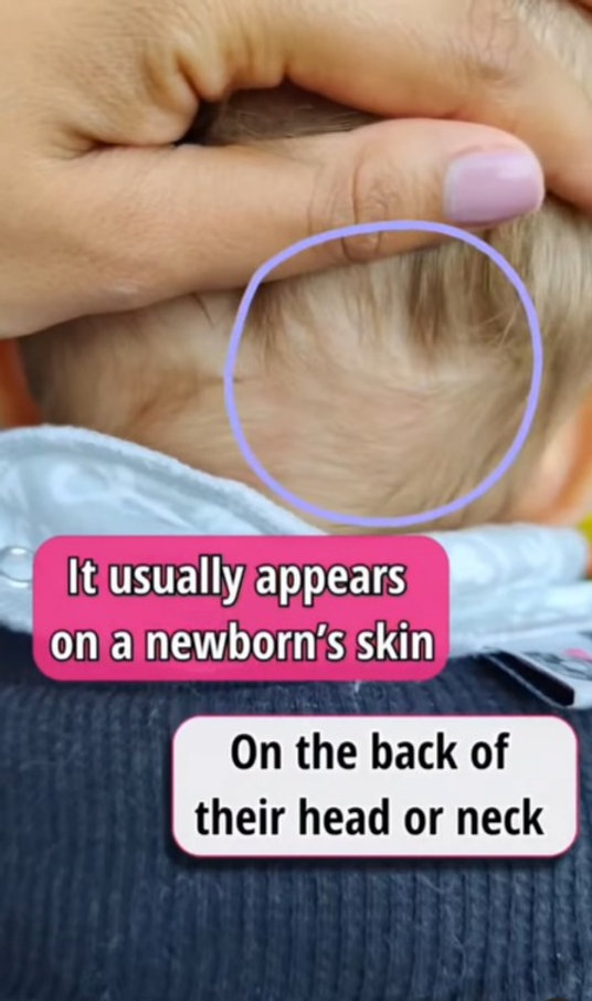 Does your baby has Stork Bite