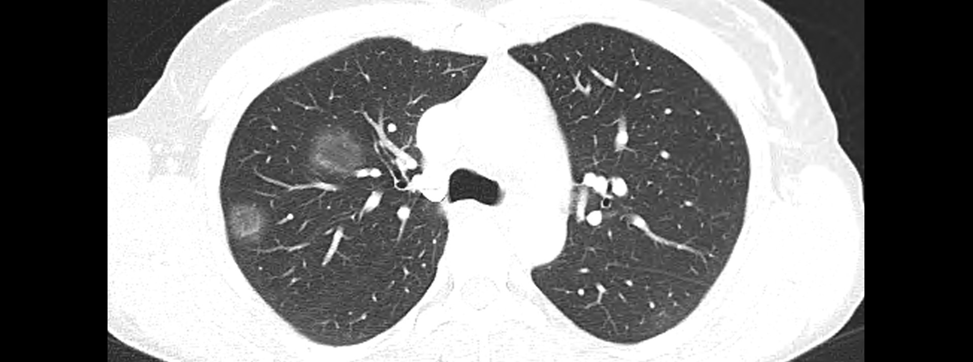 UFO in Respiratory Medicine: Unclassifying the mystery of “rare“ lung ...
