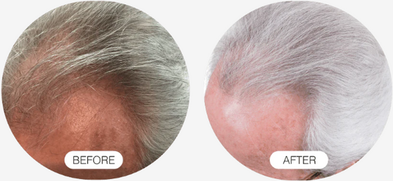 Capillus |【公式】Capillus Japan ｜「低出力レーザー 育毛」