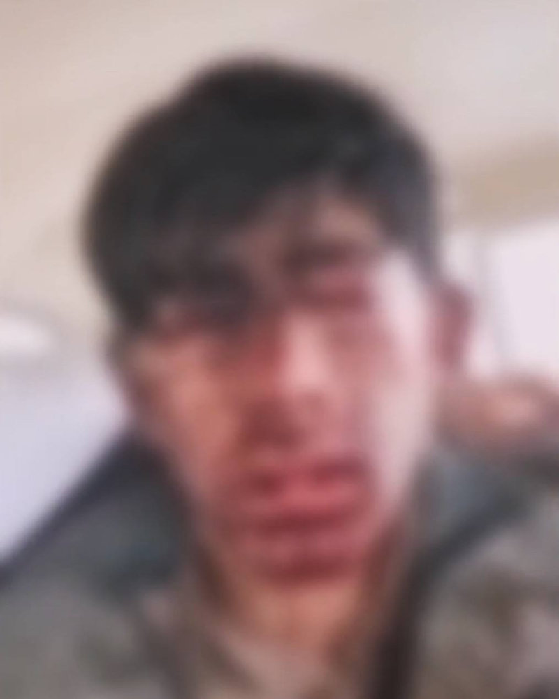 Child Kurdish Kolbar blinded in Eye by Iranian Border Guards