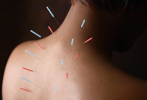 Acupuncture Alleviates Torticollis, Cervical and Neck Pain, Increases ...