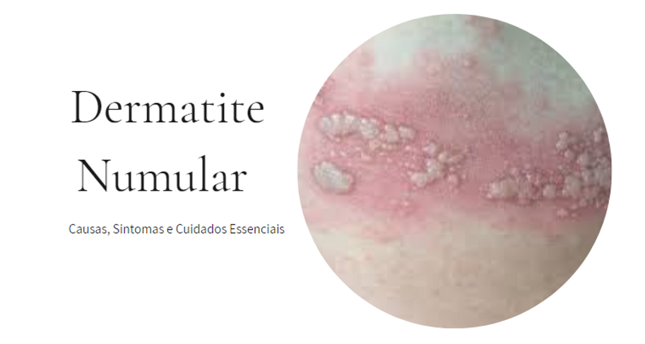Dermatite Numular: Causas, Sintomas e Cuidados Essenciais