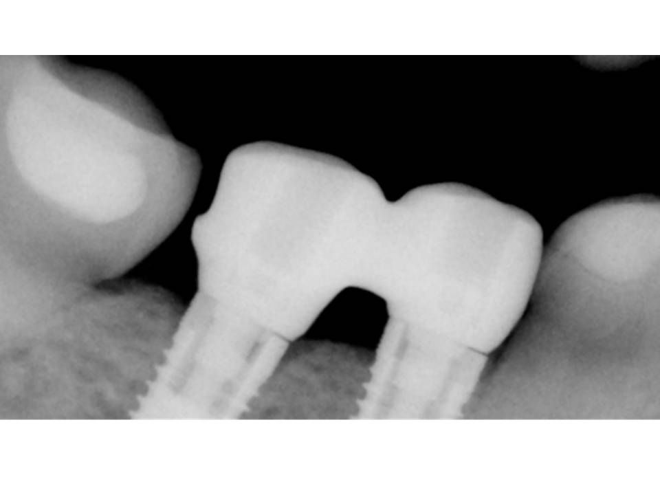 3 Hidden Causes of Implant Prosthetic Complications