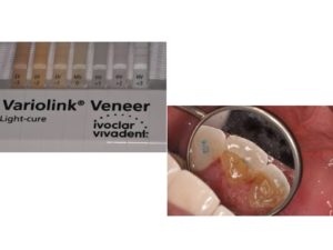 How to use Variolink Veneer, a Total-Etch Resin Cement