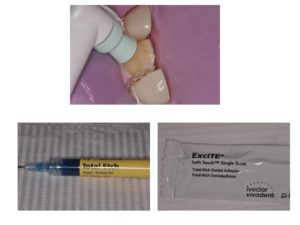 How to use Variolink Veneer, a Total-Etch Resin Cement