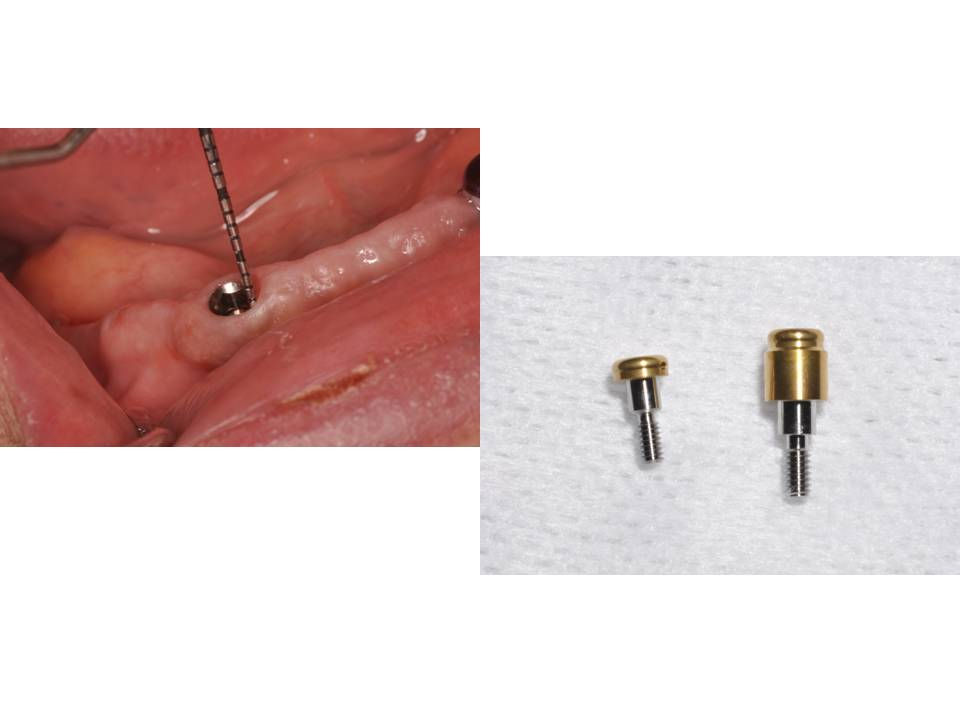 Locator Attachments for Implant Overdentures: Part 1