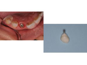 How to Make a Custom Impression Coping