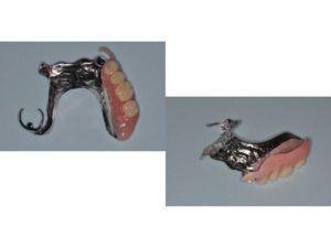 Esthetic RPD Clasp Design for Anterior Teeth