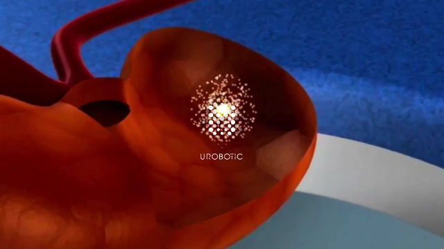 La lithiase urinaire