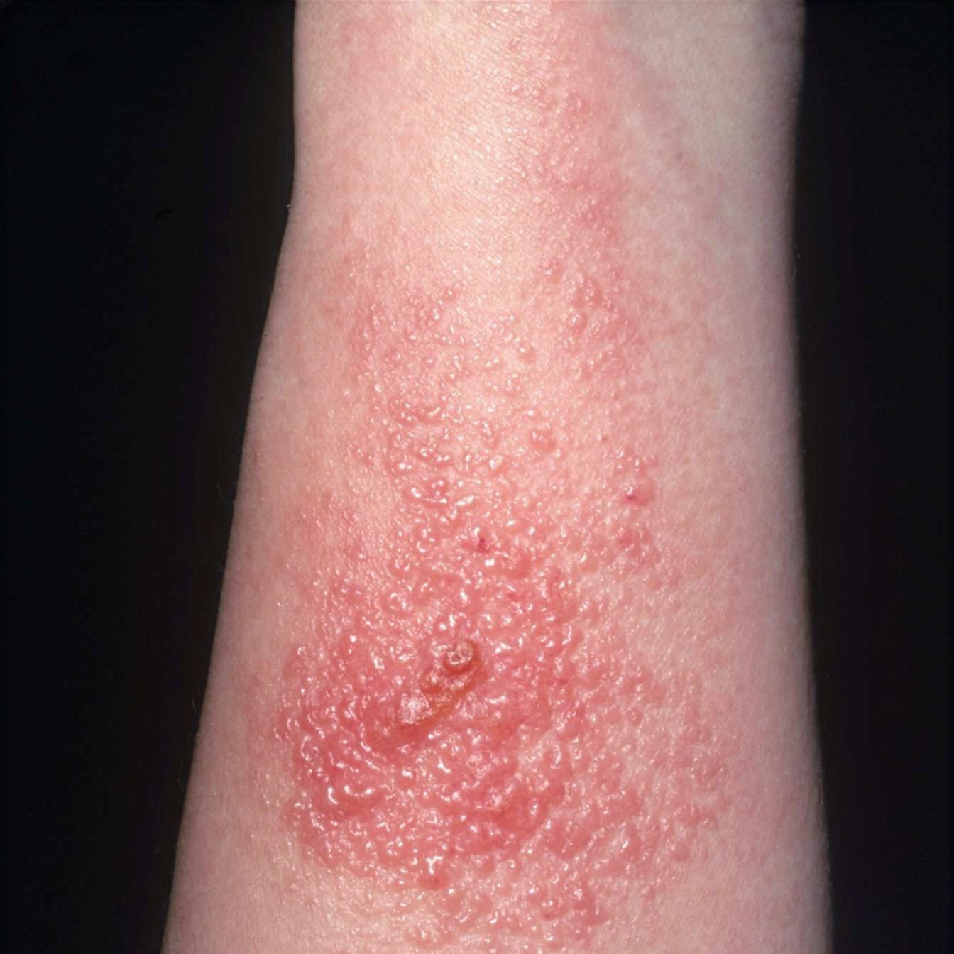 The St. Louis Dermatology Guide to Treating Poison Ivy
