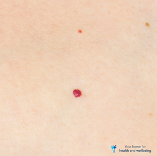Skin Tag Removal | Physical Balance | Basingstoke
