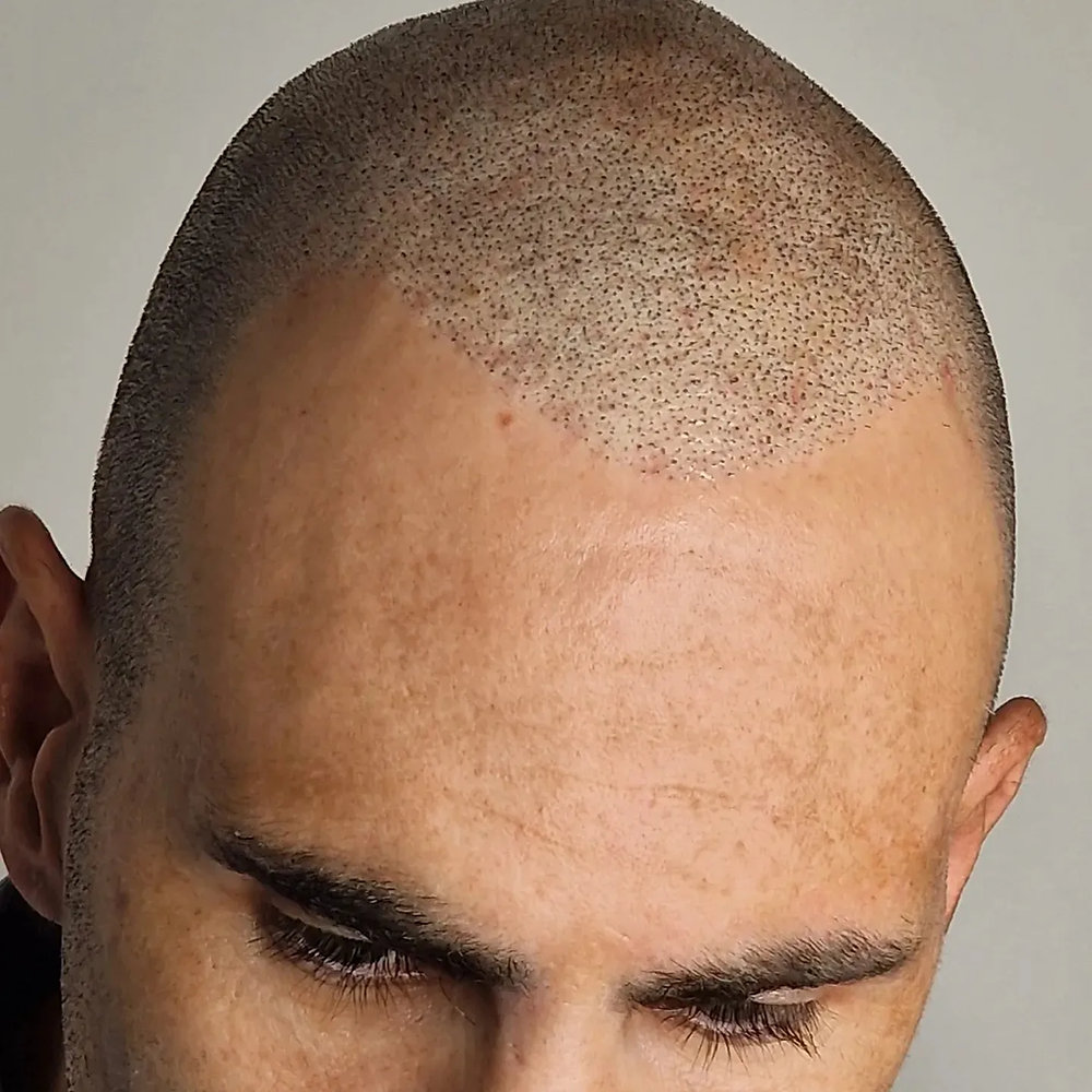 What is Scalp Micropigmentation? (SMP)