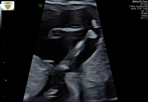 Early Anatomy Scan | Marlow | The Baby Scan Studio
