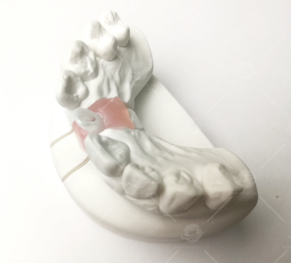 Implant | ocean-dental-lab