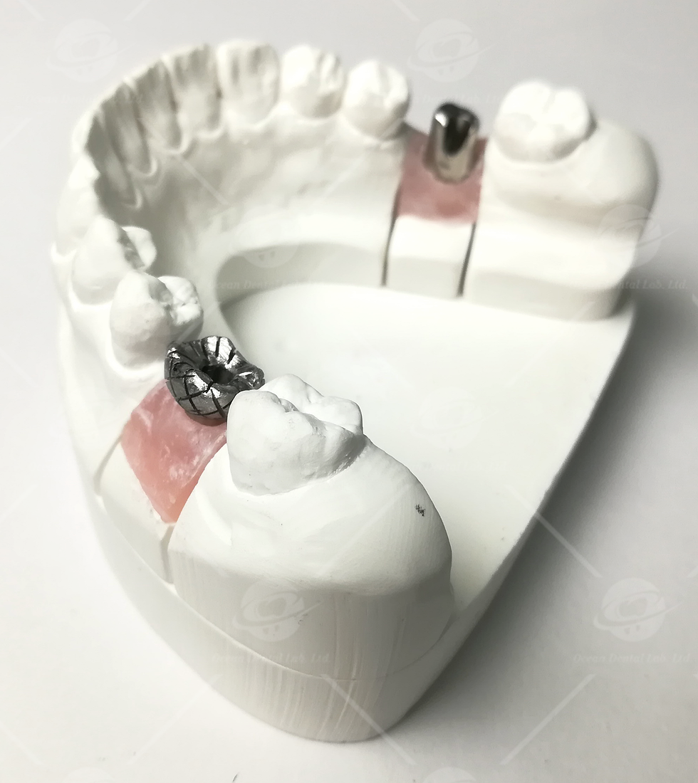 Implant | ocean-dental-lab