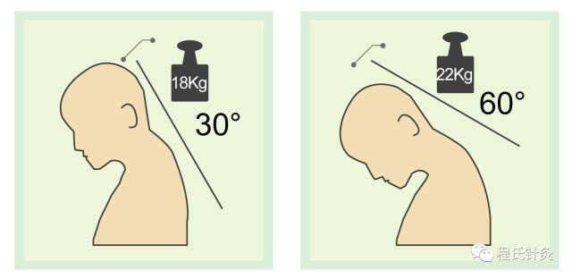 Neck Pain | A Note to Those Who Bend Neck All Day