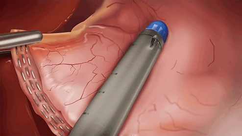 The Evolution of Innovation in Laparoscopic Surgical Stapling - towards the Universal Staple ...