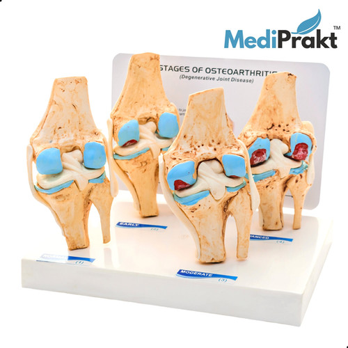 Knee Joint Arthritis Model | 4 Stage Osteoarthritis | For Demonstration ...