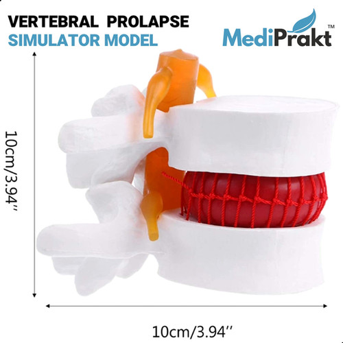 Vertebral Prolapse Simulator Model | Herniated Disc Model| MediPrakt