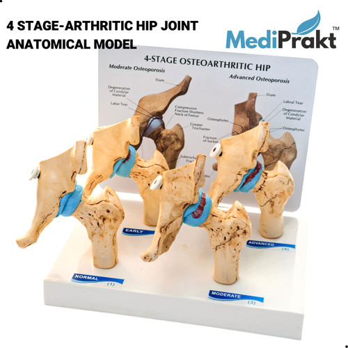 4 STAGE HIP JOINT ARTHRITIS MODEL | Osteoarthritis Model| MediPrakt