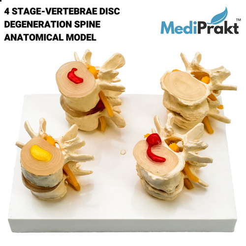 4 STAGE DISC DEGENERATION SPINE MODEL| MediPrakt