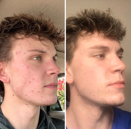 PURE Face Care | Meet Suzanne