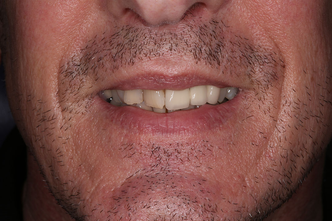 What is Smile Design with Porcelain Veneers?