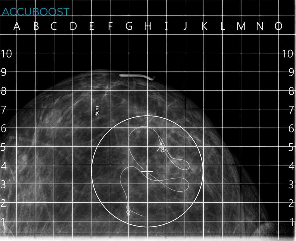 VeraForm® Demonstrating Broad Treatment Applicability