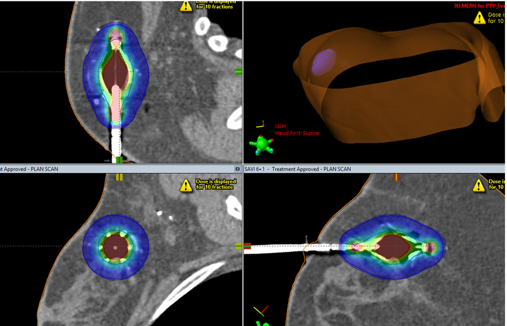 APBI with VeraForm® & SAVI® Brachytherapy: Marking for the Unpredictable
