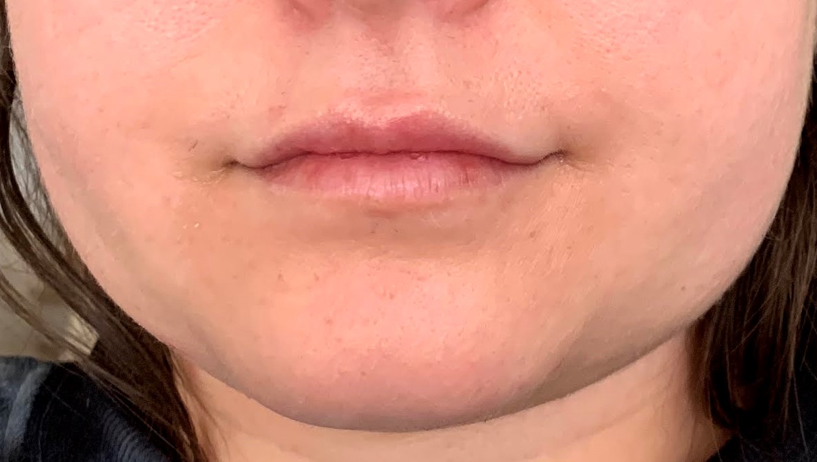 I Wanted Natural Looking Plumped Lips. My Lip Filler Experience.