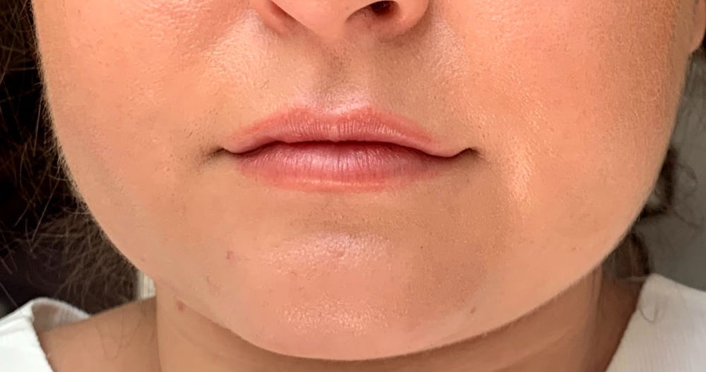 I Wanted Natural Looking Plumped Lips. My Lip Filler Experience.