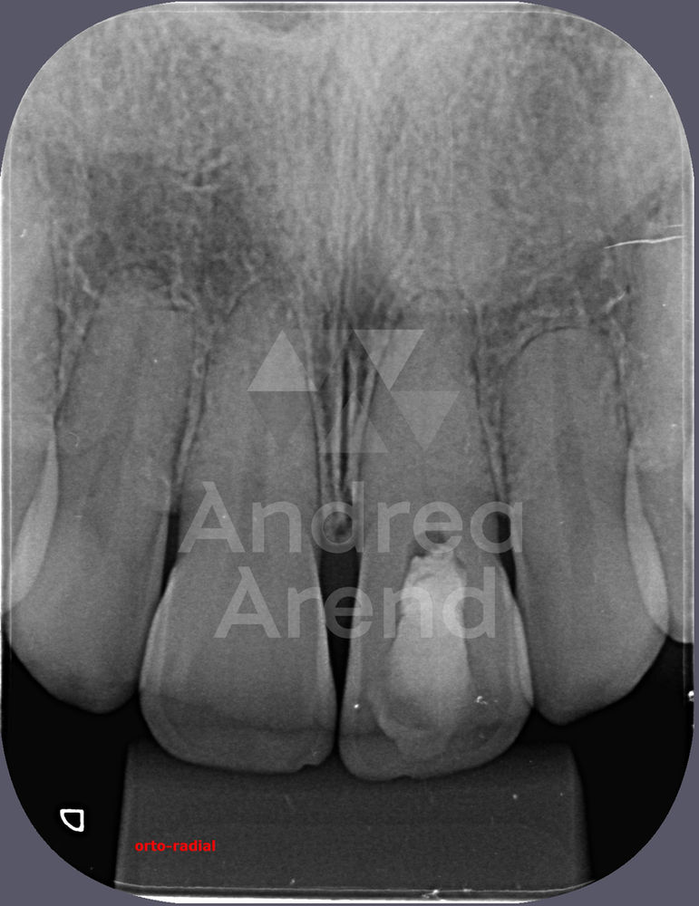 Calcificação Incisivo – Dente 11