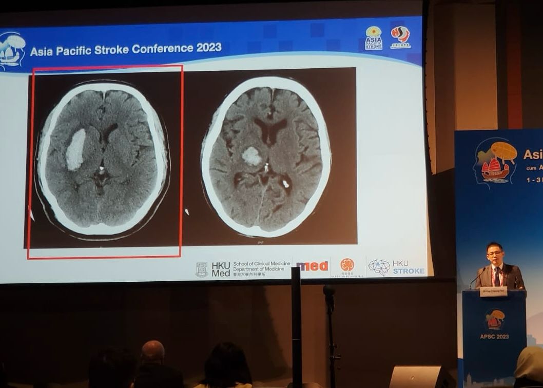 Asia Pacific Stroke Conference 2023