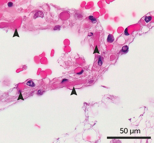 Cellix Solutions mimic microvascular thrombosis accelerating COVID-19
