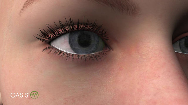 Punctal Plugs: A Guide to Understanding and Treating Dry Eye Syndrome