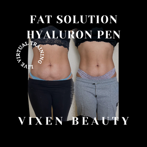Hyaluron Pen Training (for Fat Solution) - IN PERSON | Vixen Beauty