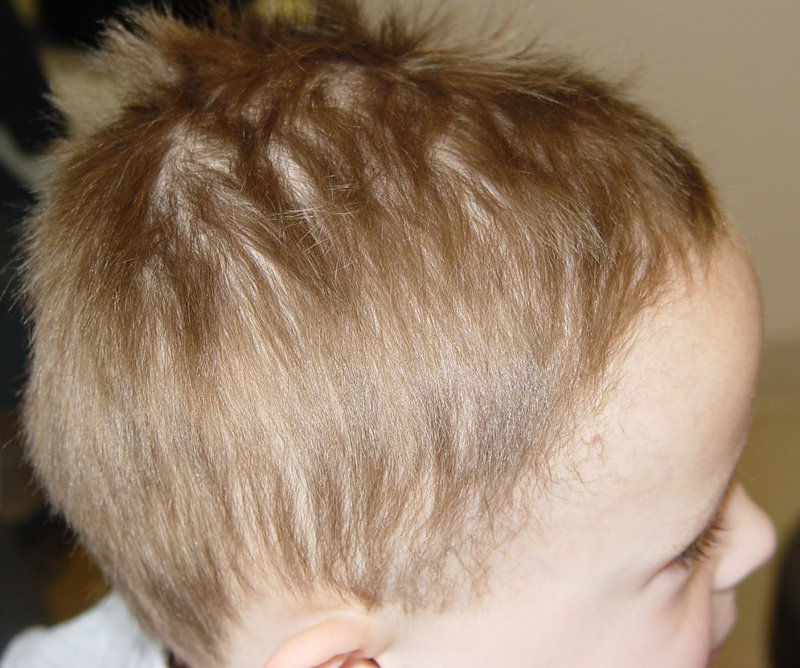 Las alteraciones estructurales del cabello