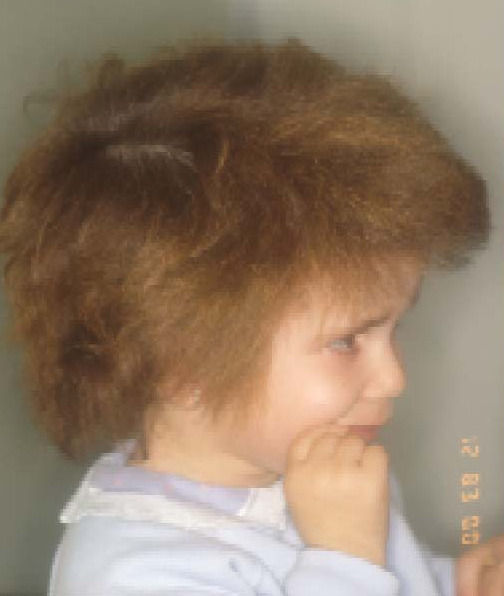 Las alteraciones estructurales del cabello