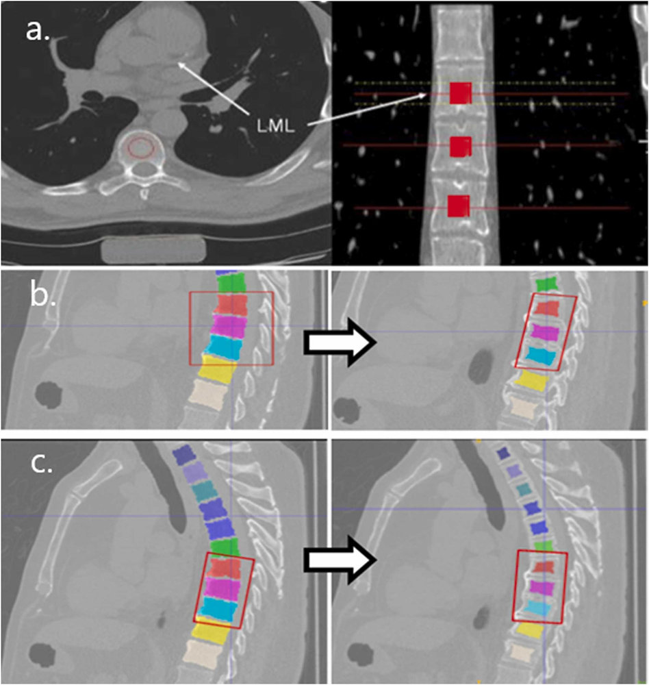 Opportunistic AI-enabled automated bone mineral density measurements