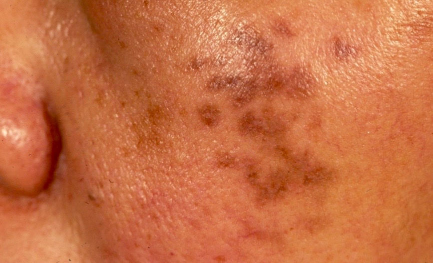 Facial Pigmentation