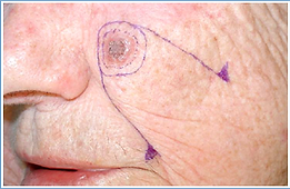 Rodent Ulcers - about the surgical removal of rodent ulcers