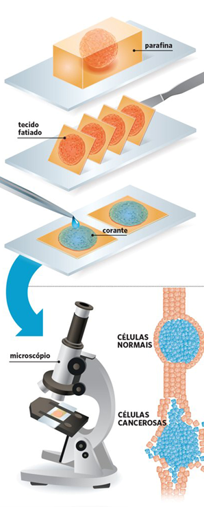 ENTENDA O EXAME DE BIÓPSIA | Para que serve e como é feita.