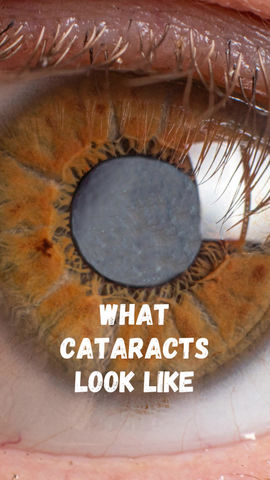 What is the First Sign of Cataracts? Causes and Symptoms of Cataracts ...