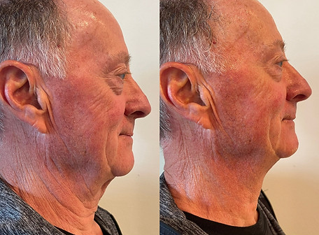 Neveskin Before & After | My Vxw Site 6x5l8u