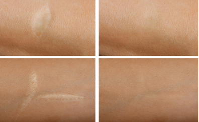 Paramedical- Stretch-mark & Scar Correction Training- NYC | NJ | OLP ...