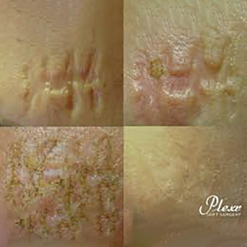 Plexr Plus Fibroblast Keloid Scar 0-5cm | Myomy Wellness
