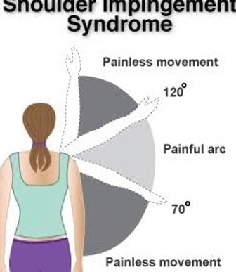 Shoulder Impingement: Causes, Symptoms, and Treatment