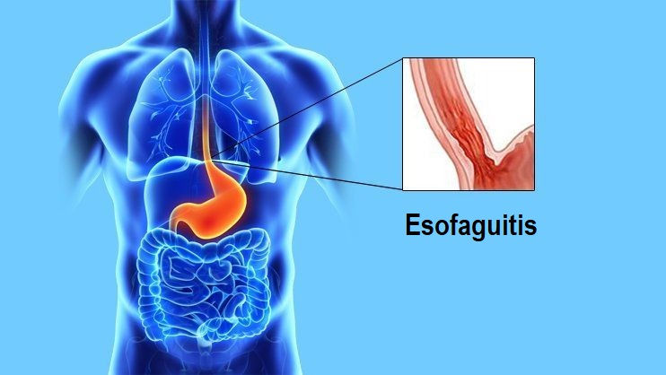 Esofaguitis grado 3 | indutorescelulares